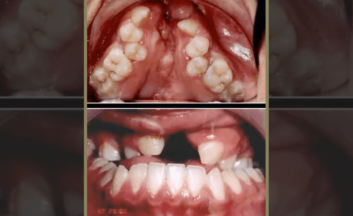 Cleft and Congential Deformities