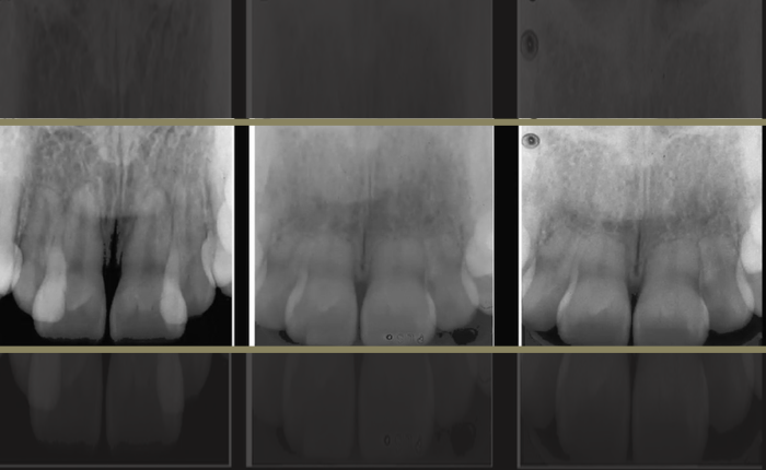 Root Resorption